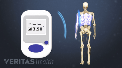 Spinal Cord Stimulation for Chronic Back Pain Video | Spine-health