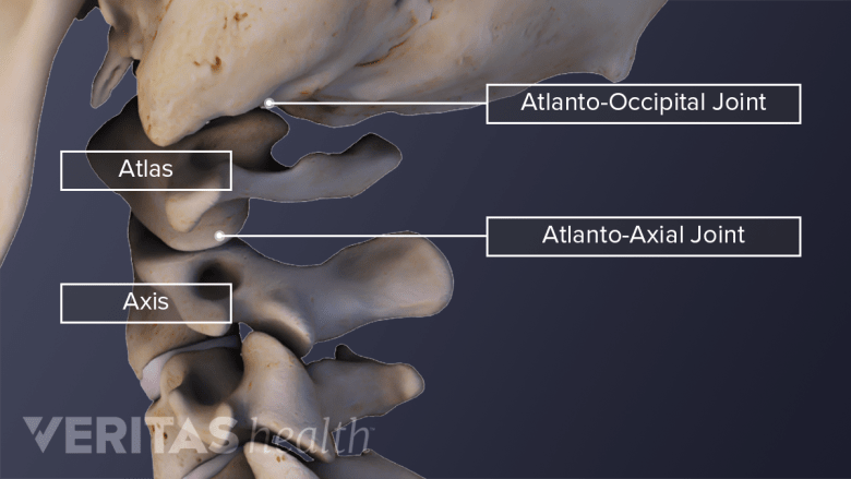 What Is Cervicogenic Headache? | Spine-health