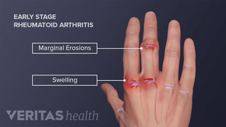 9 Little-Known Life Hacks for Living with Arthritis Hand Pain ...