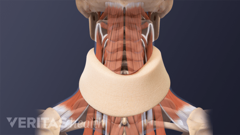 Potential Risks and Complications of ACDF Surgery | Spine-health
