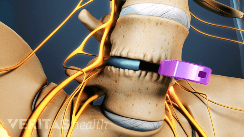 Surgical Treatments for Degenerative Disc Disease | Spine-health