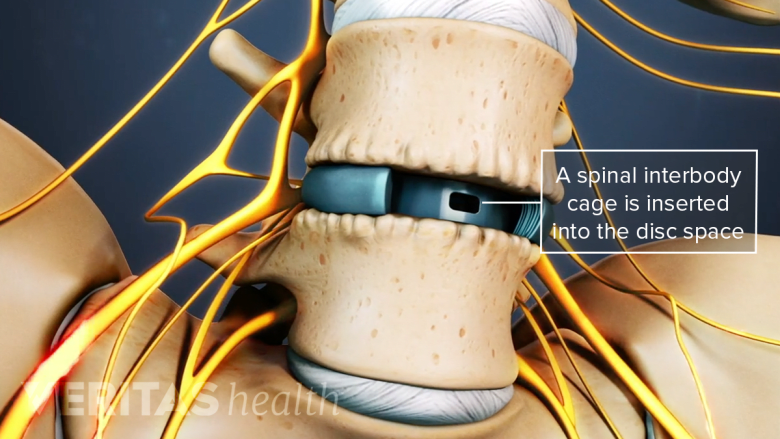 Lumbar Spinal Fusion Surgery | Spine-health