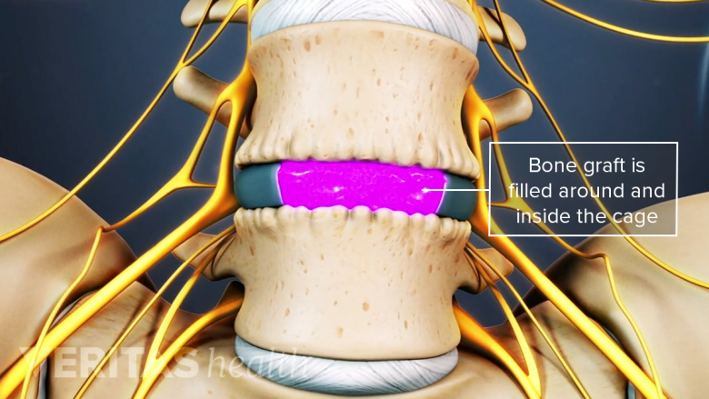 Posterior Lumbar Interbody Fusion (PLIF) Surgery | Spine-health