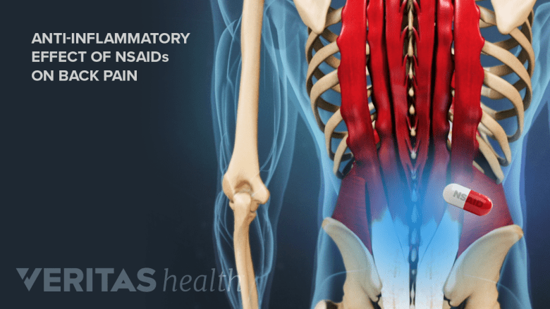 Top 3 Over-the-Counter Remedies for Back Pain (Plus a Fourth) | Spine ...