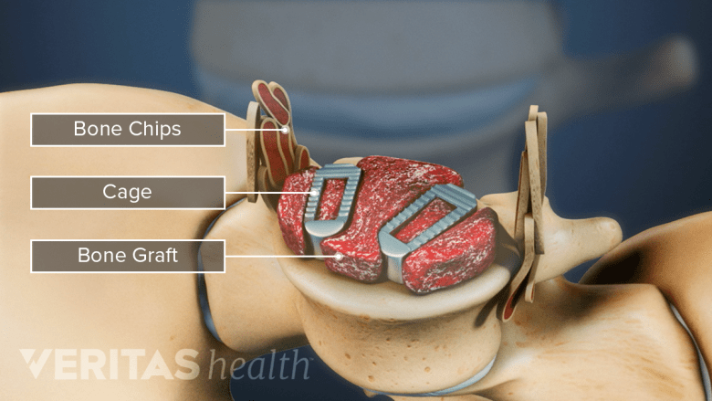 Allograft: Bone Graft from a Donor | Spine-health