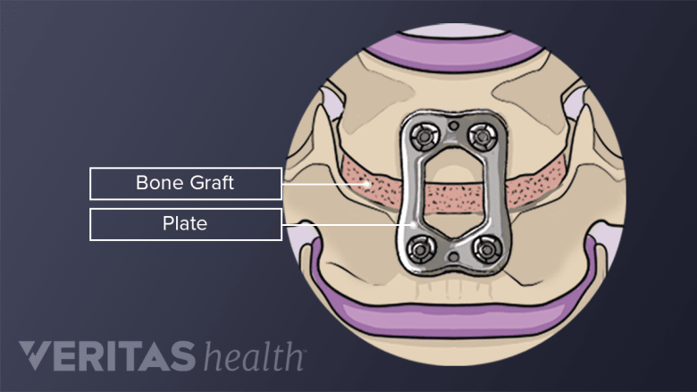 C1-C2 Treatment | Spine-health