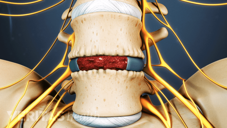 Failed Spinal Fusion Surgery | Spine-health