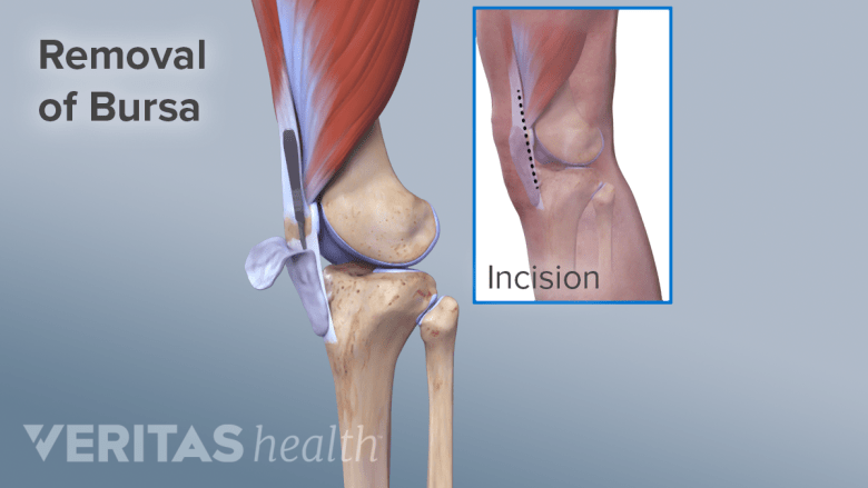 Bursitis Treatment and Prevention | Arthritis-health