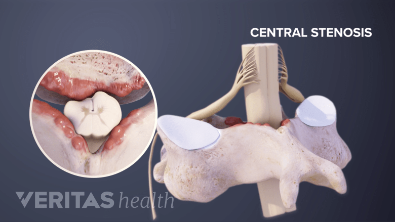 Central Canal Stenosis | Spine-health