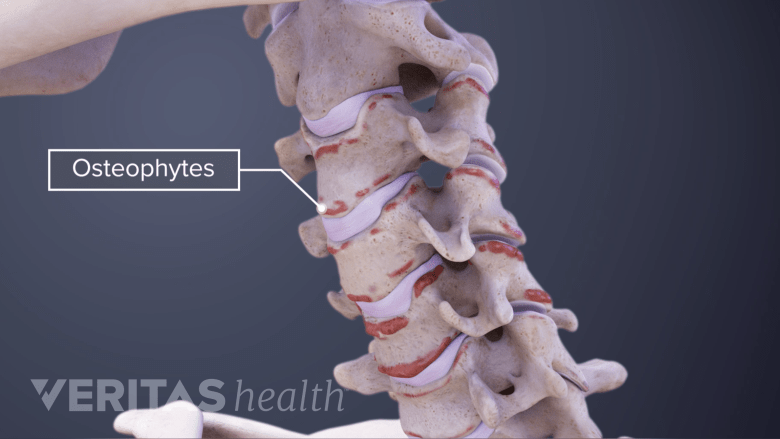 Cervical Osteophytes: Bone Spurs in the Neck | Spine-health
