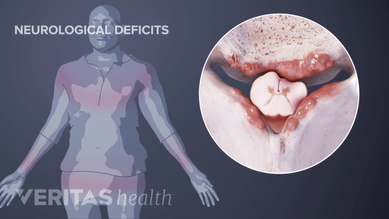 Cervical Foraminal Stenosis Causes and Diagnosis | Spine-health