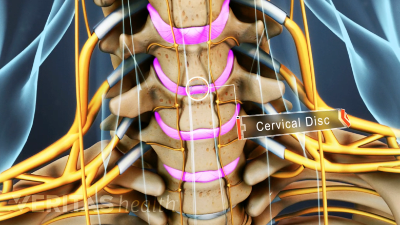 Spinal Discs | Spine-health
