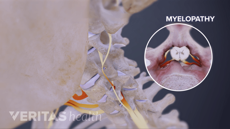 Cervical Stenosis with Myelopathy | Spine-health