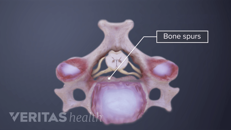 Clinical Symptoms of Bone Spurs | Spine-health
