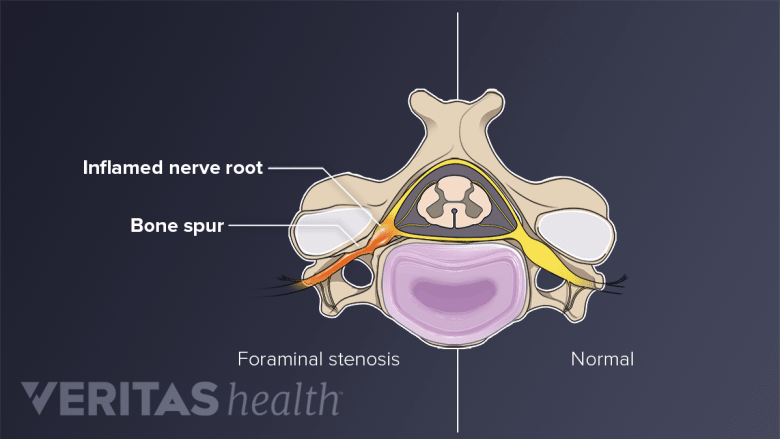 Cervical Osteoarthritis (Neck Arthritis) | Spine-health