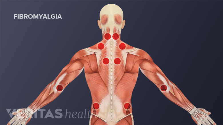 Neck Pain from Fibromyalgia | Spine-health
