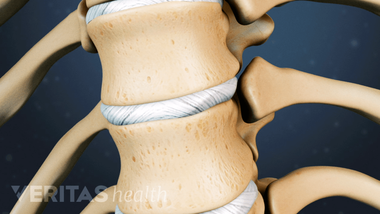 Thoracic Discs | Spine-health