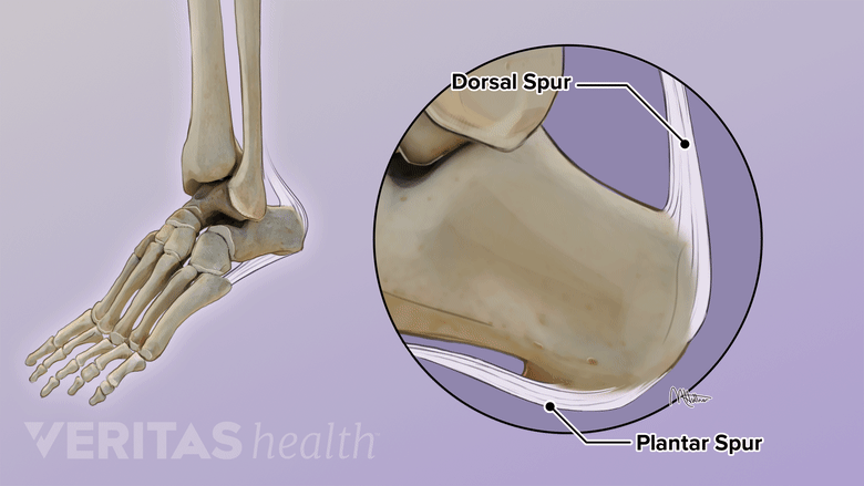 Calcaneal Spur Heel Spurs Treatment New York, NY | Plantar Fasciitis