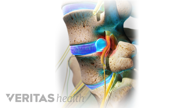 What's a Herniated Disc, Pinched Nerve, Bulging Disc...? | Spine-health