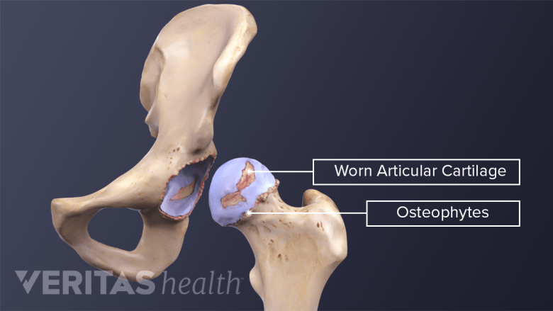 What Is Hip Osteoarthritis? | Arthritis-health