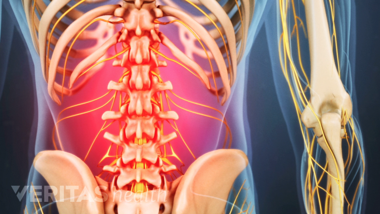 Pulled Back Muscle and Lower Back Strain | Spine-health