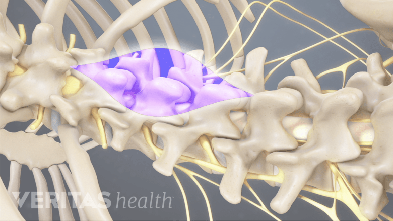 Transforaminal Lumbar Interbody Fusion (TLIF) Back Surgery | Spine-health