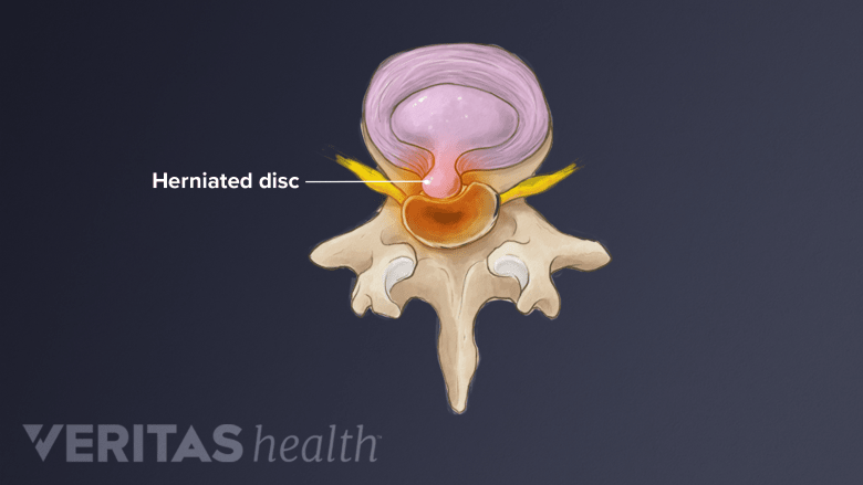 Microdiscectomy (Microdecompression) Spine Surgery | Spine-health