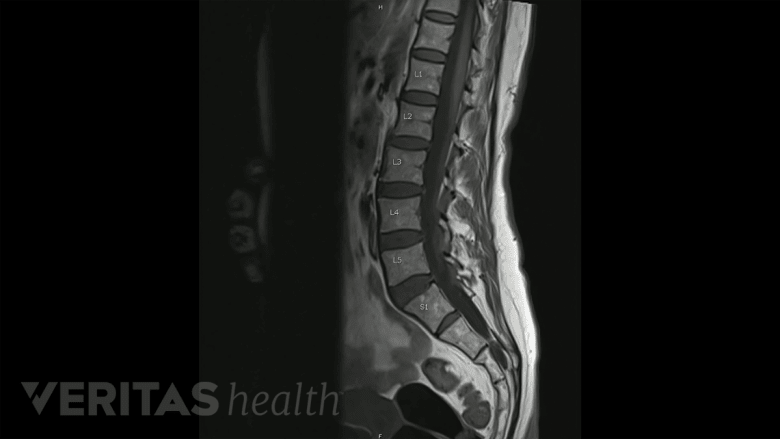 The "Degenerative Cascade" of a Degenerating Disc | Spine-health