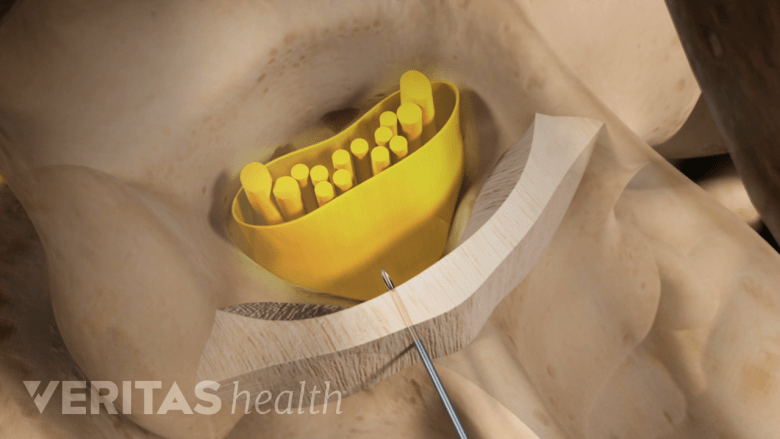 Tratamiento del segmento L5-S1 | Spine-health