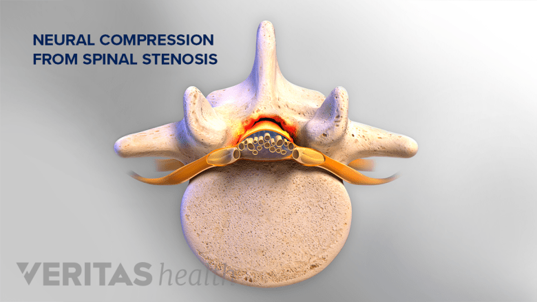 Living with Lumbar Spinal Stenosis | Spine-health