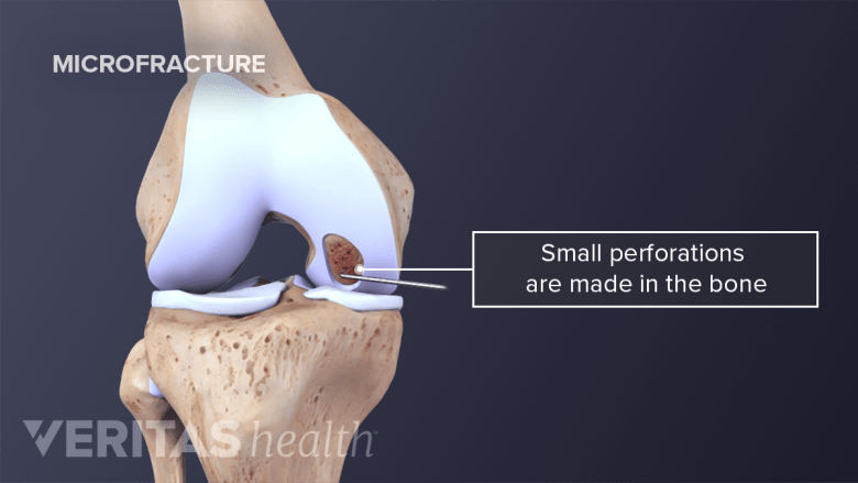 Can Damaged Cartilage Be Fixed? | Sports-health
