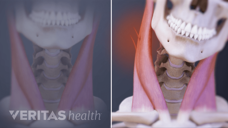Understanding Neck Spasms | Spine-health