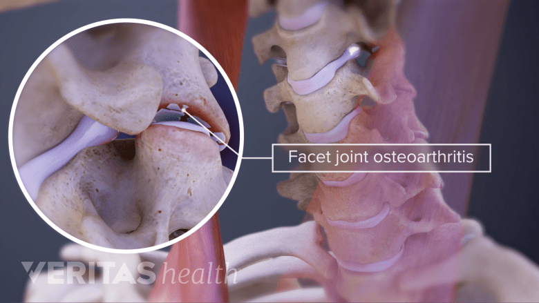 Bone Spur Causes | Spine-health