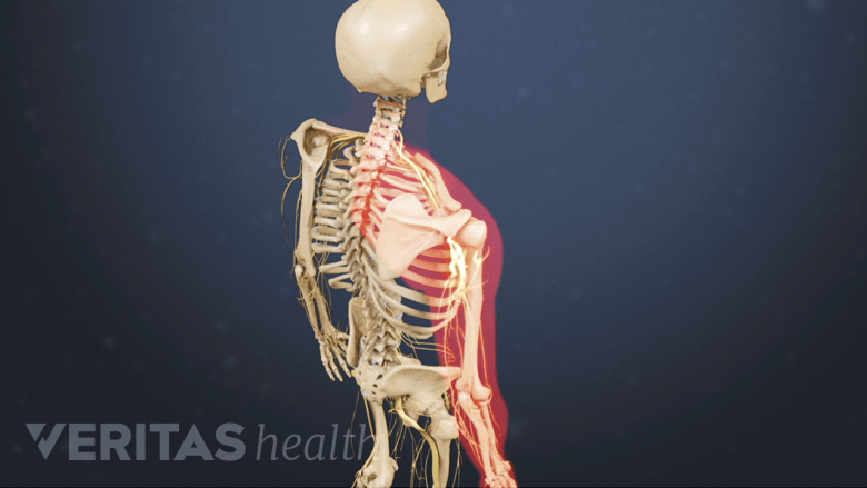 Cervical Foraminal Stenosis | Spine-health