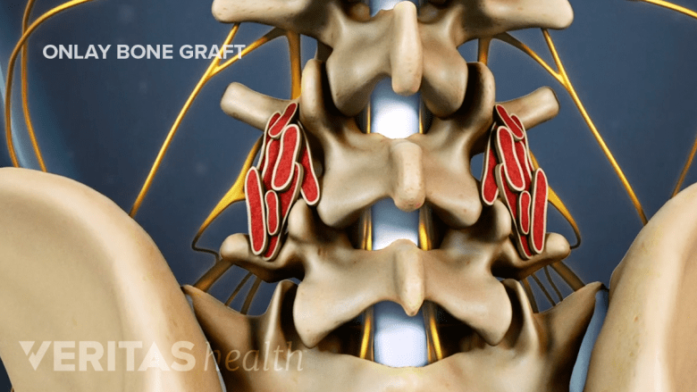 Bone Graft for Spine Fusion | Spine-health