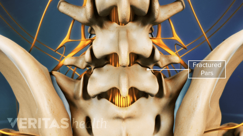 Isthmic Spondylolisthesis | Spine-health