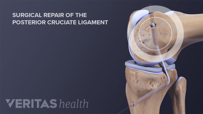 Posterior Cruciate Ligament (PCL) Tear Treatment Options | Sports-health