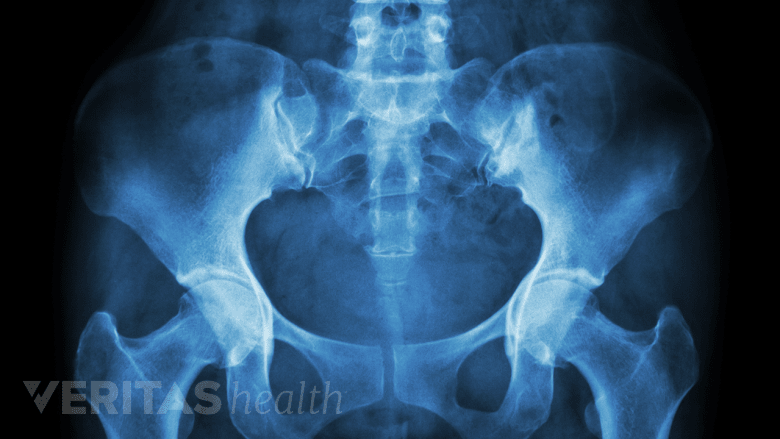 Diagnosis of Bone Spurs | Spine-health