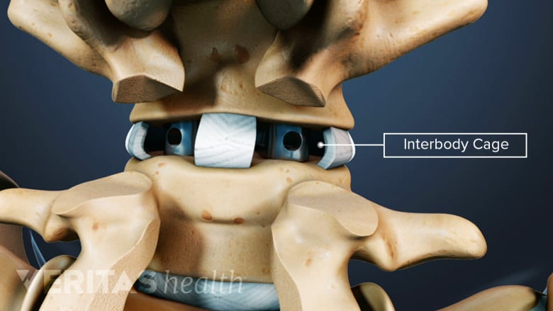Interbody Cages for Spine Fusion | Spine-health
