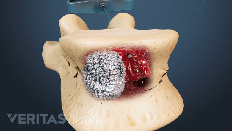 Kyphoplasty Risks and Potential Complications | Spine-health