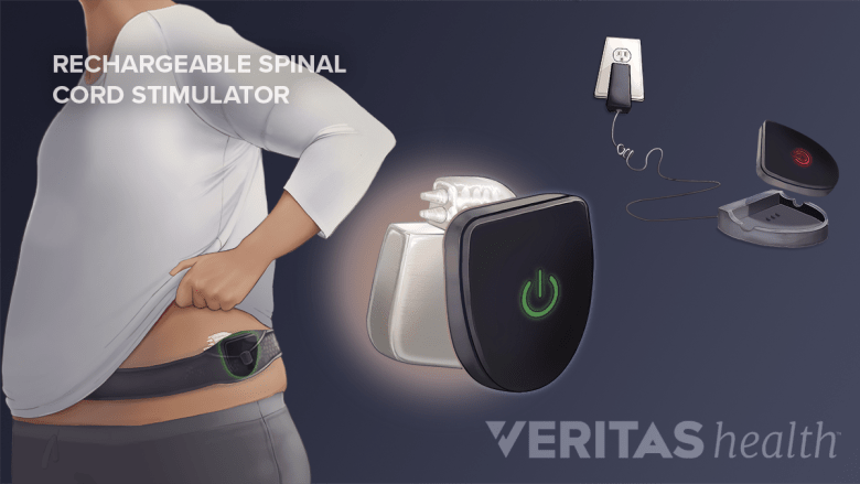 Recharging a Rechargeable SCS | Spine-health