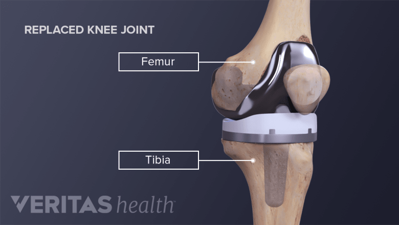 Types of Knee Surgery for Arthritis Treatment | Arthritis-health