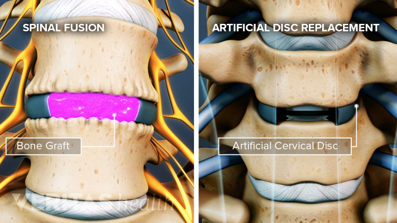 Cervical Artificial Disc Replacement Surgery | Spine-health