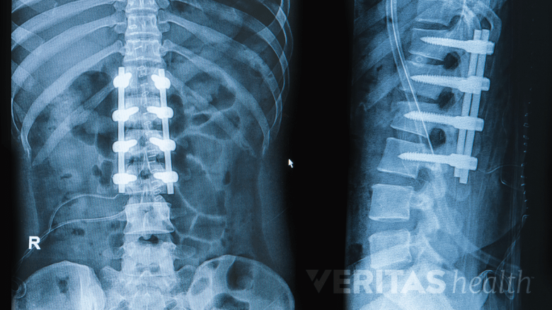 Types of Lumbar Spine Surgeries: What You Need to Know | Spine-health