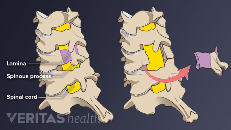 Posterior Cervical Laminectomy | Spine-health