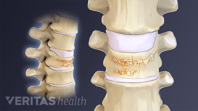 Osteoporosis: The Primary Cause of Collapsed Vertebrae | Spine-health