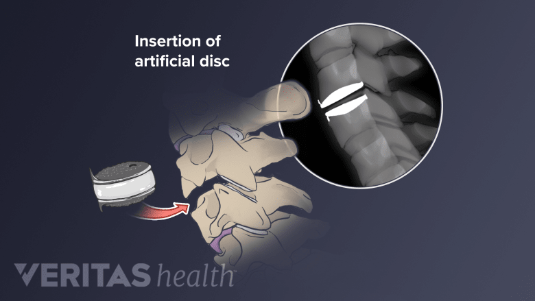 Cervical Artificial Disc Replacement Technologies | Spine-health