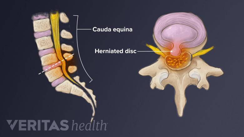 Médula espinal y cola de caballo de la columna lumbar | Spine-health