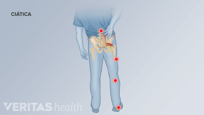 Inervación y función del músculo del nervio ciático | Spine-health