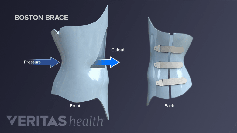Types of Scoliosis Braces | Spine-health